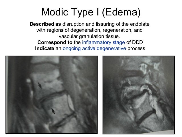 The modic vertebral endplate and marrow changes (spine 2010)