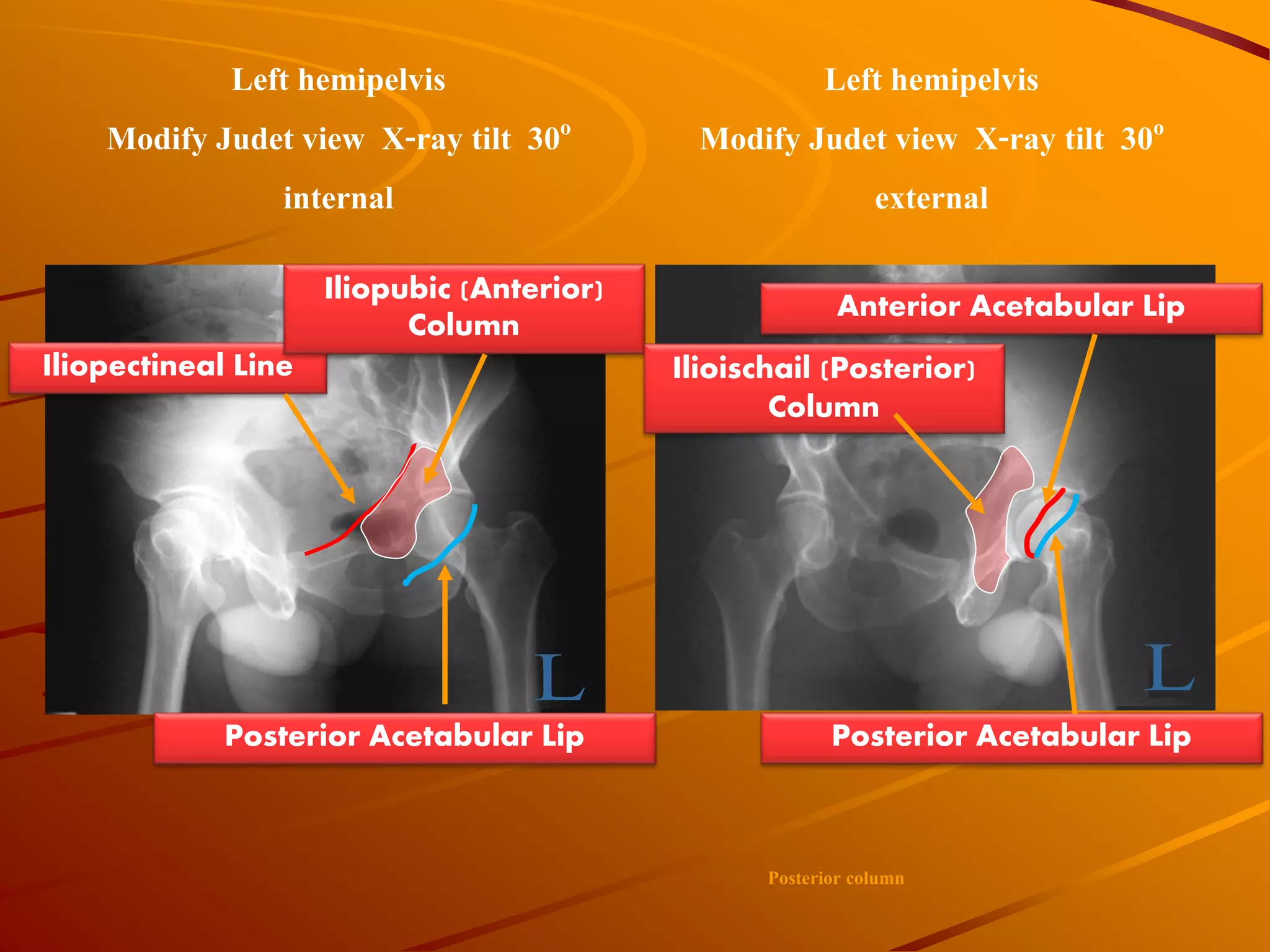 The modification plain radiographic of pelvis | PDF