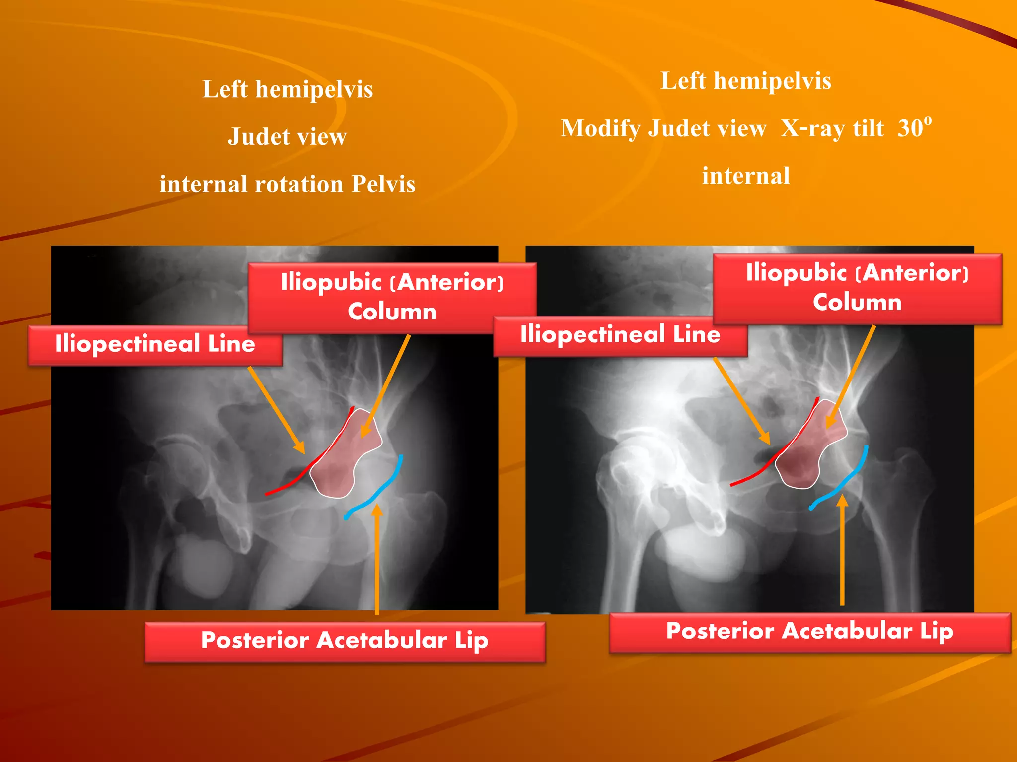 The modification plain radiographic of pelvis | PDF