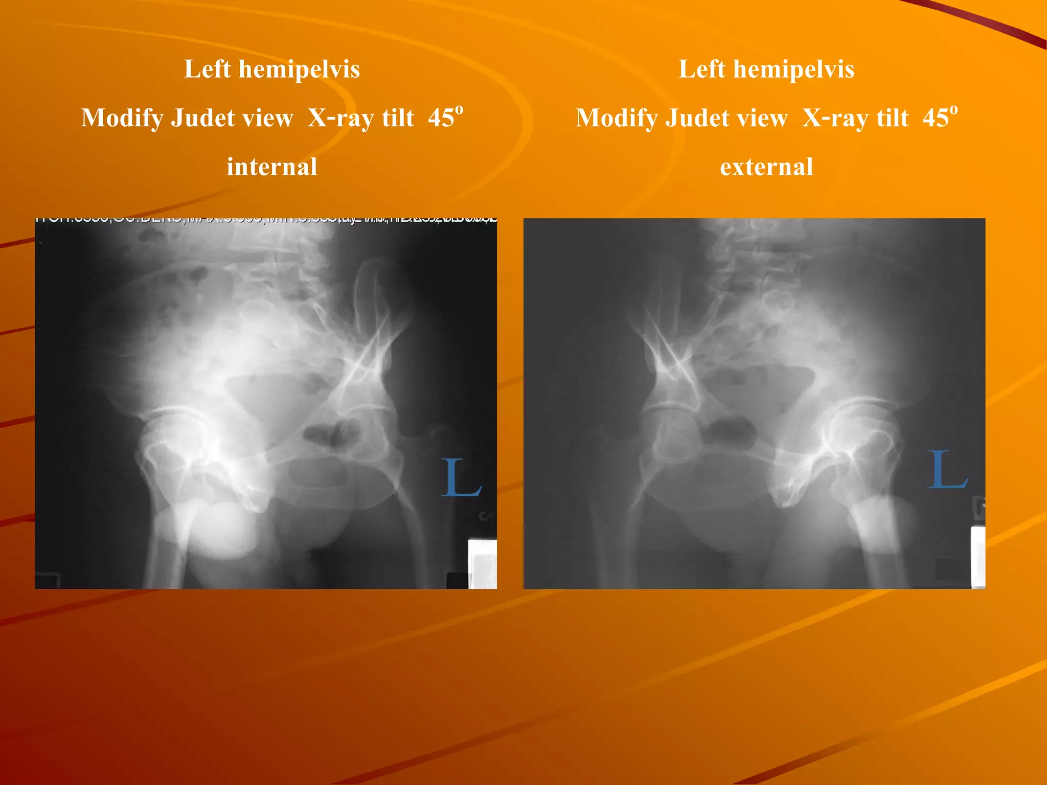 The modification plain radiographic of pelvis | PDF