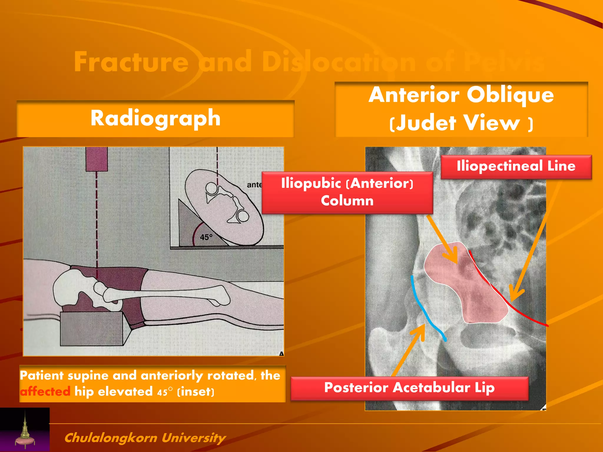 The modification plain radiographic of pelvis | PDF