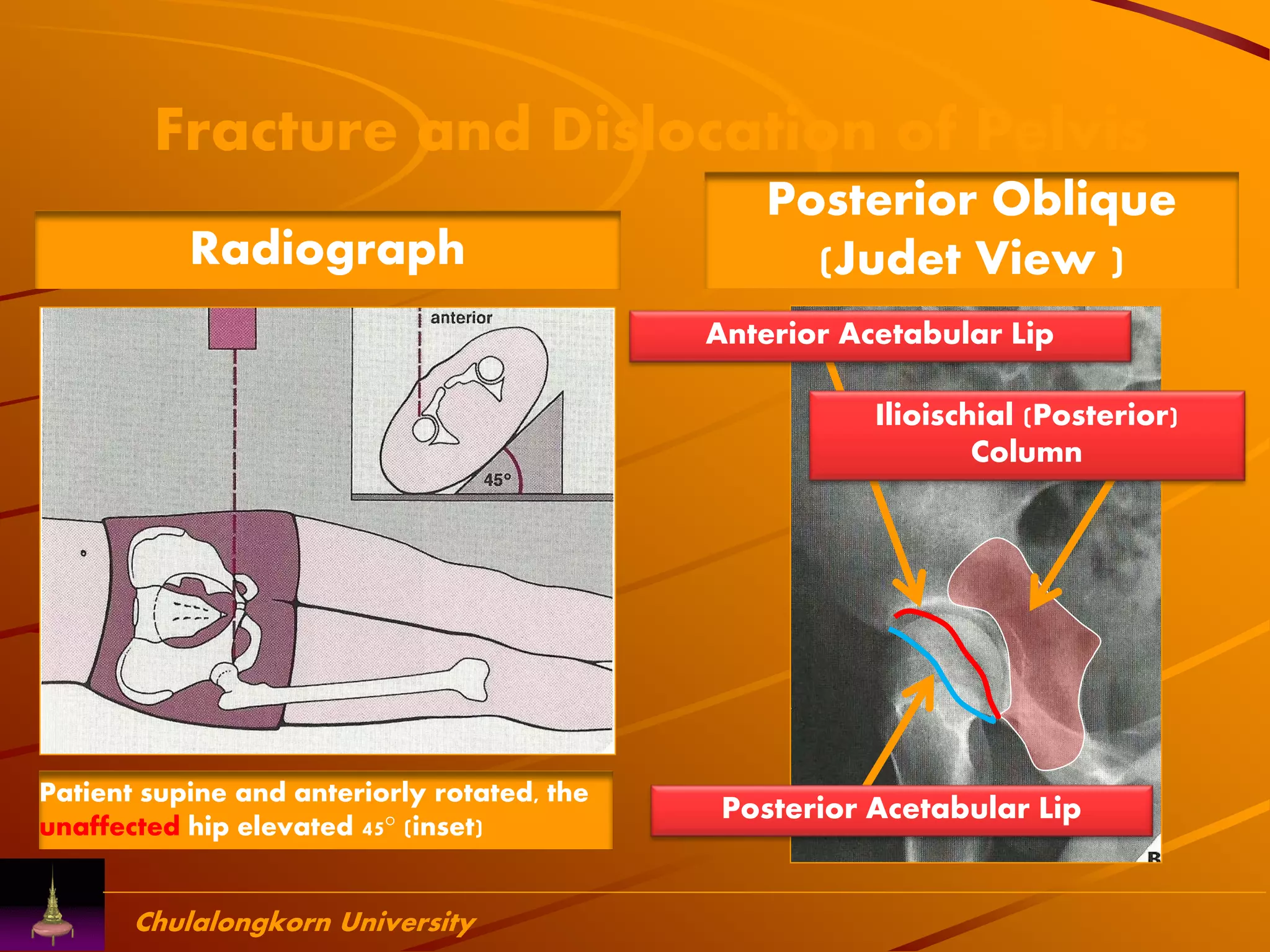 The modification plain radiographic of pelvis | PDF