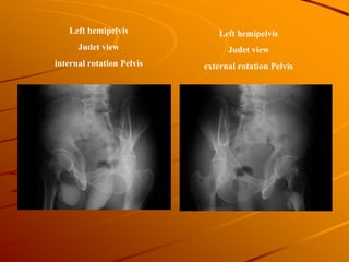 The modification plain radiographic of pelvis | PDF
