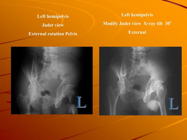 The modification plain radiographic of pelvis