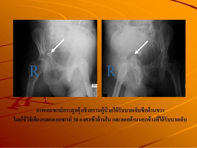 The modification plain radiographic of pelvis