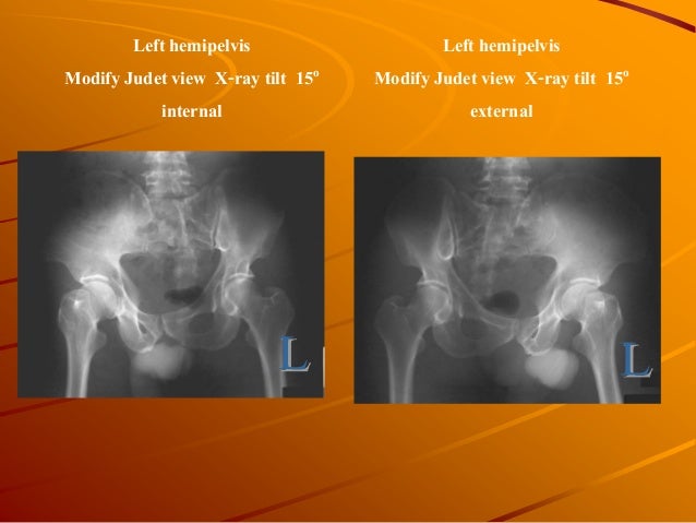 The modification plain radiographic of pelvis