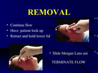 Morgan Lens for ALS Providers | PPT