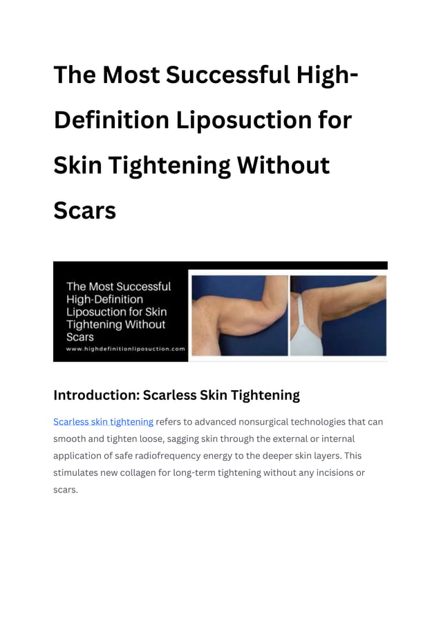 The Most Successful High-Definition Liposuction for Skin Tightening ...