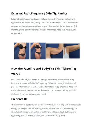 The Most Successful High-Definition Liposuction for Skin Tightening ...