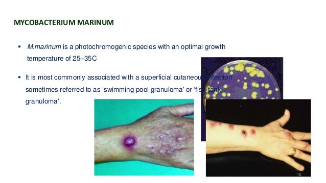 The mycobacterium avium complex and slowly growing mycobacterium