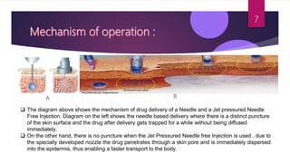 theneedlefreeinjectiontechnology-181030132529.pptx