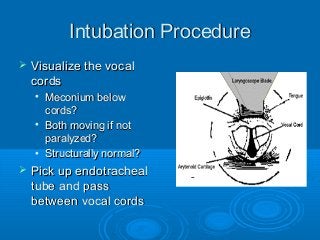 The neonatal airway | PPT