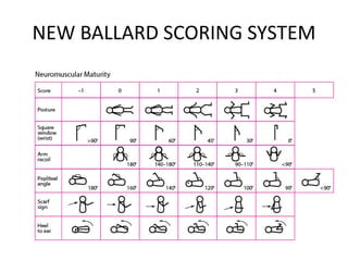 THE NEONATE NEW BALLARD SCORING SYSTEM .pptx