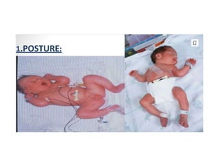 THE NEONATE NEW BALLARD SCORING SYSTEM .pptx
