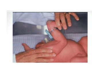 THE NEONATE NEW BALLARD SCORING SYSTEM .pptx