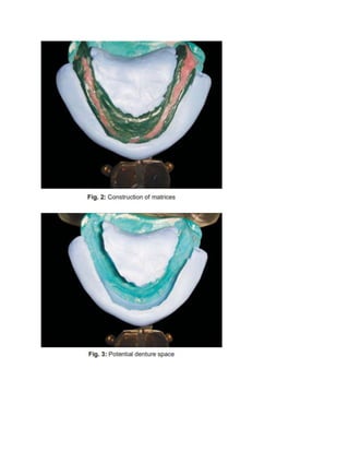 The neutral zone concept in complete denture final | DOCX