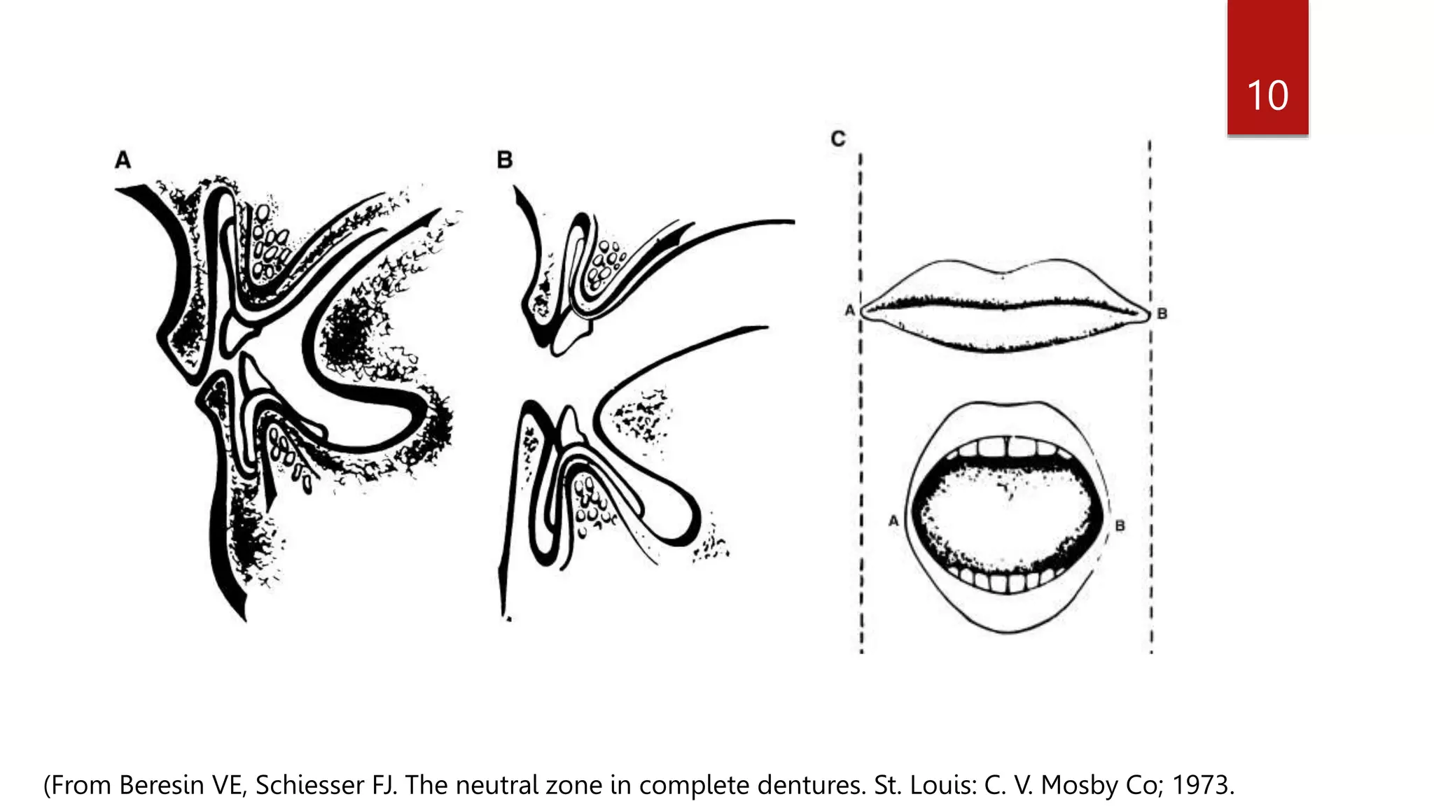 The Neutral zone in complete dentures.pptx