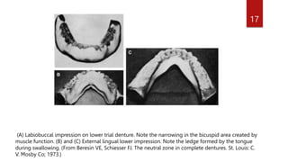 The Neutral zone in complete dentures.pptx