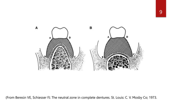 The Neutral zone in complete dentures.pptx
