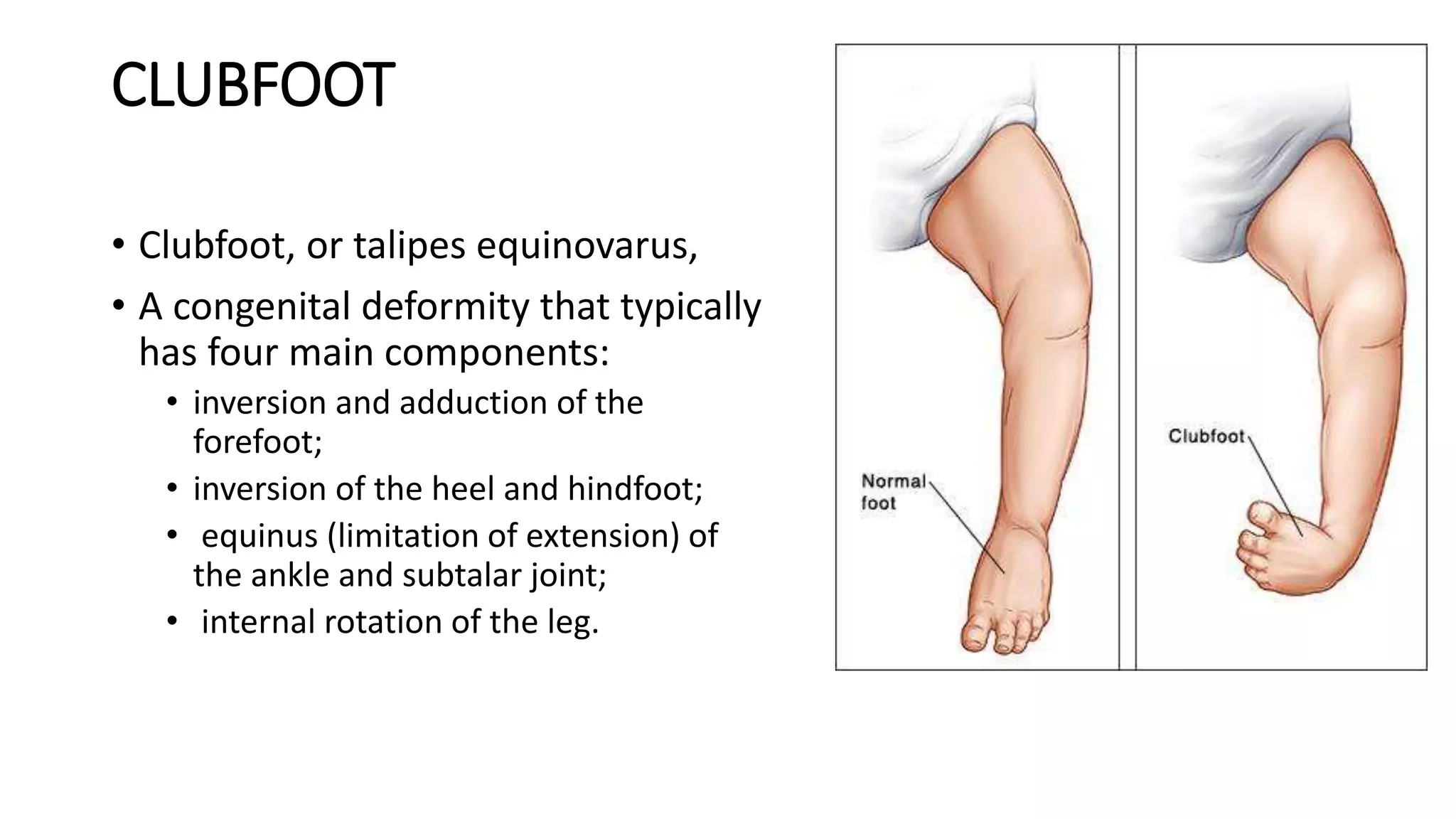 The newborn foot anomalies | PPTX