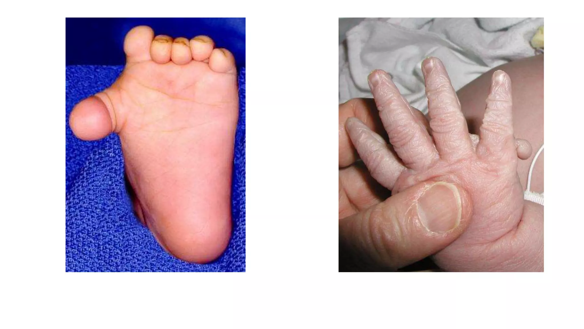 The newborn foot anomalies | PPTX | Death, Injury, or Military Conflict ...