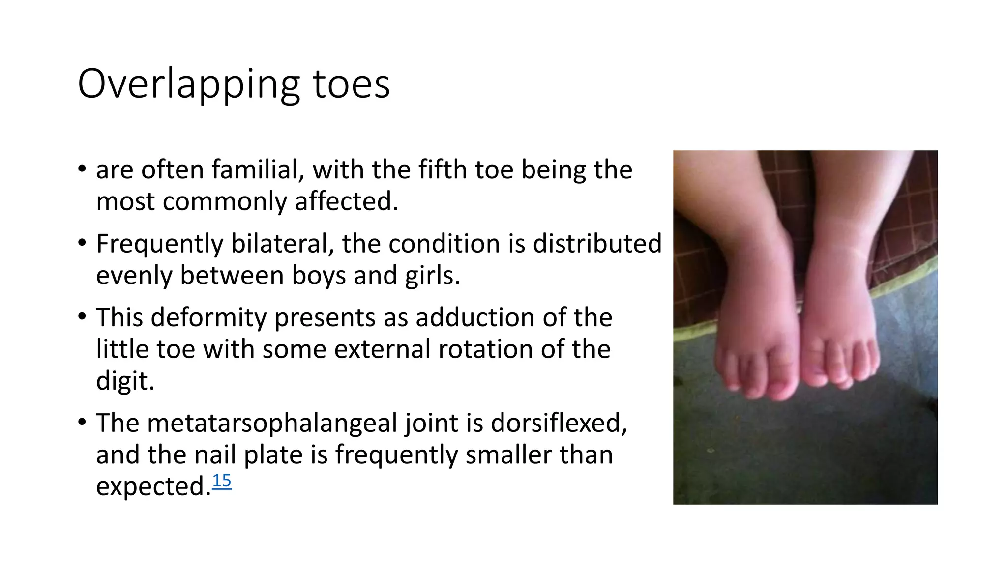 The newborn foot anomalies | PPT