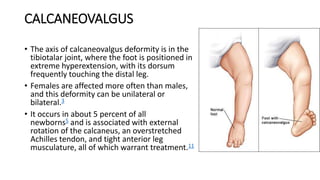 Bilateral Calcaneovalgus