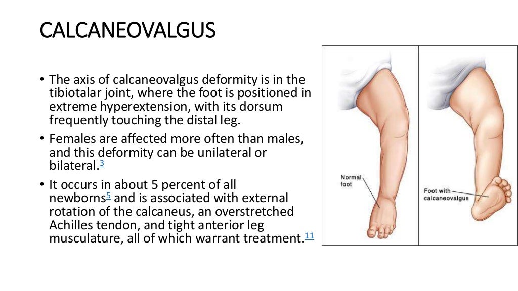 The newborn foot anomalies