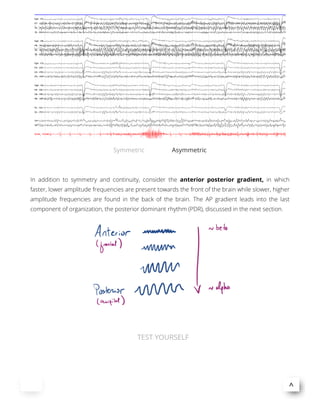The normal awake eeg and how to under .. | PDF | Brain and Nervous ...