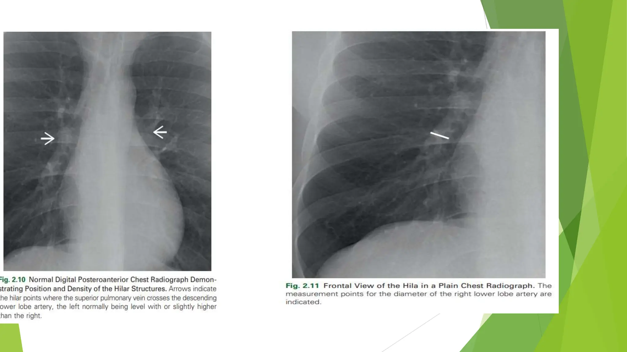 The Normal Chest anatomy in radiology.pptx