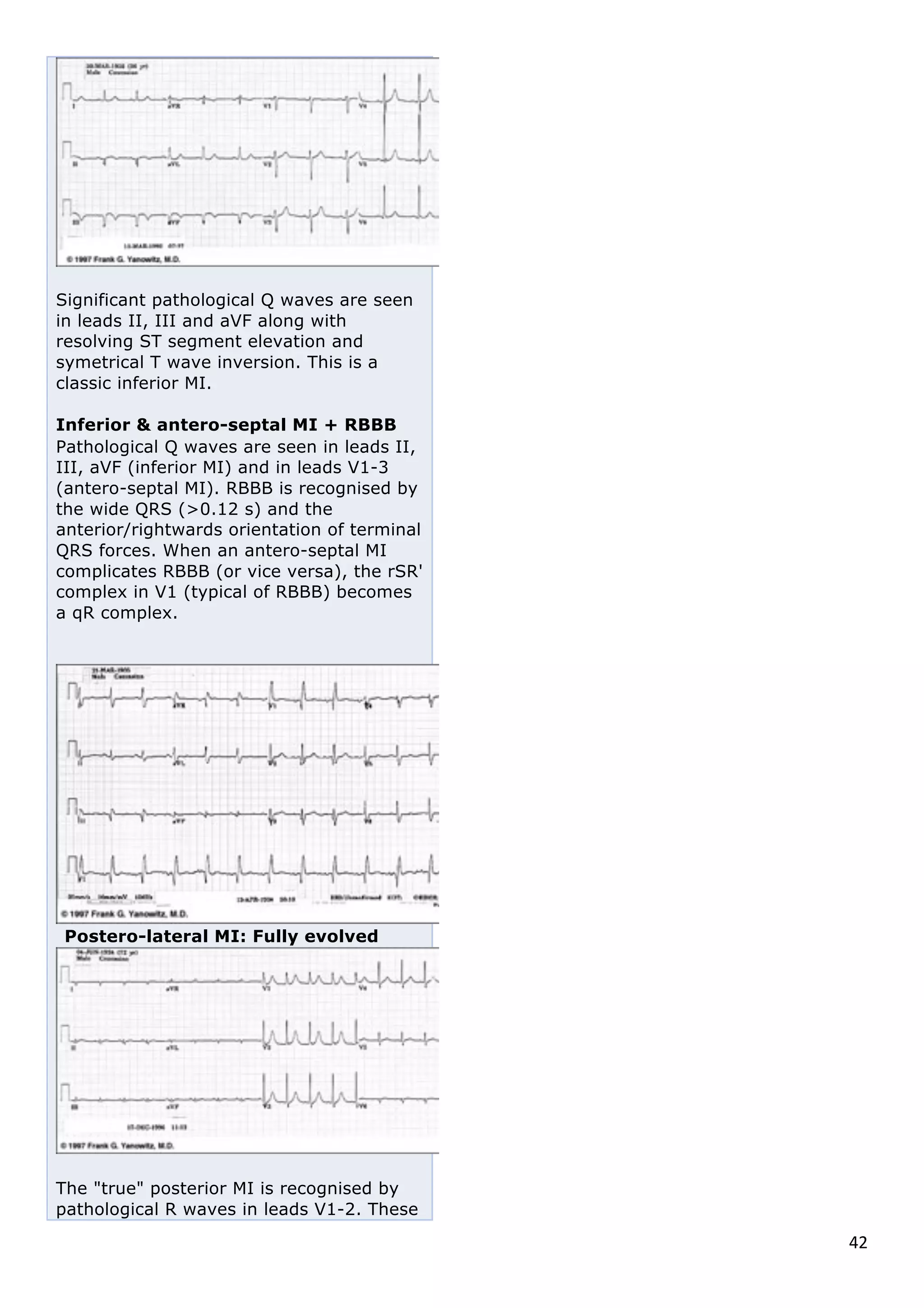 The normal ecg and the 12 | PDF | Chemistry | Science
