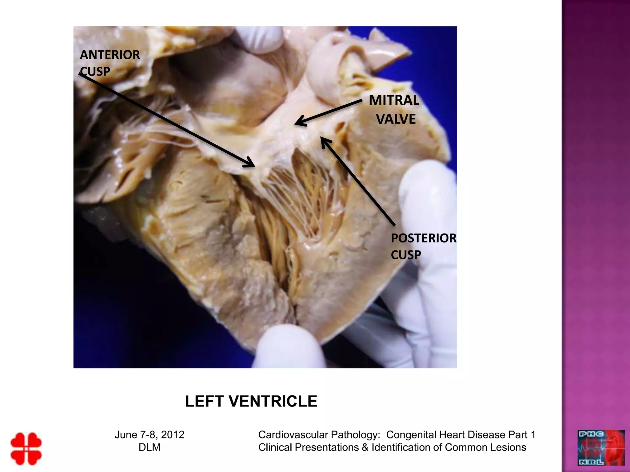 The Normal Heart: Review of Important Anatomic Landmarks | PPTX