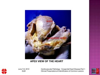 The Normal Heart: Review of Important Anatomic Landmarks | PPTX