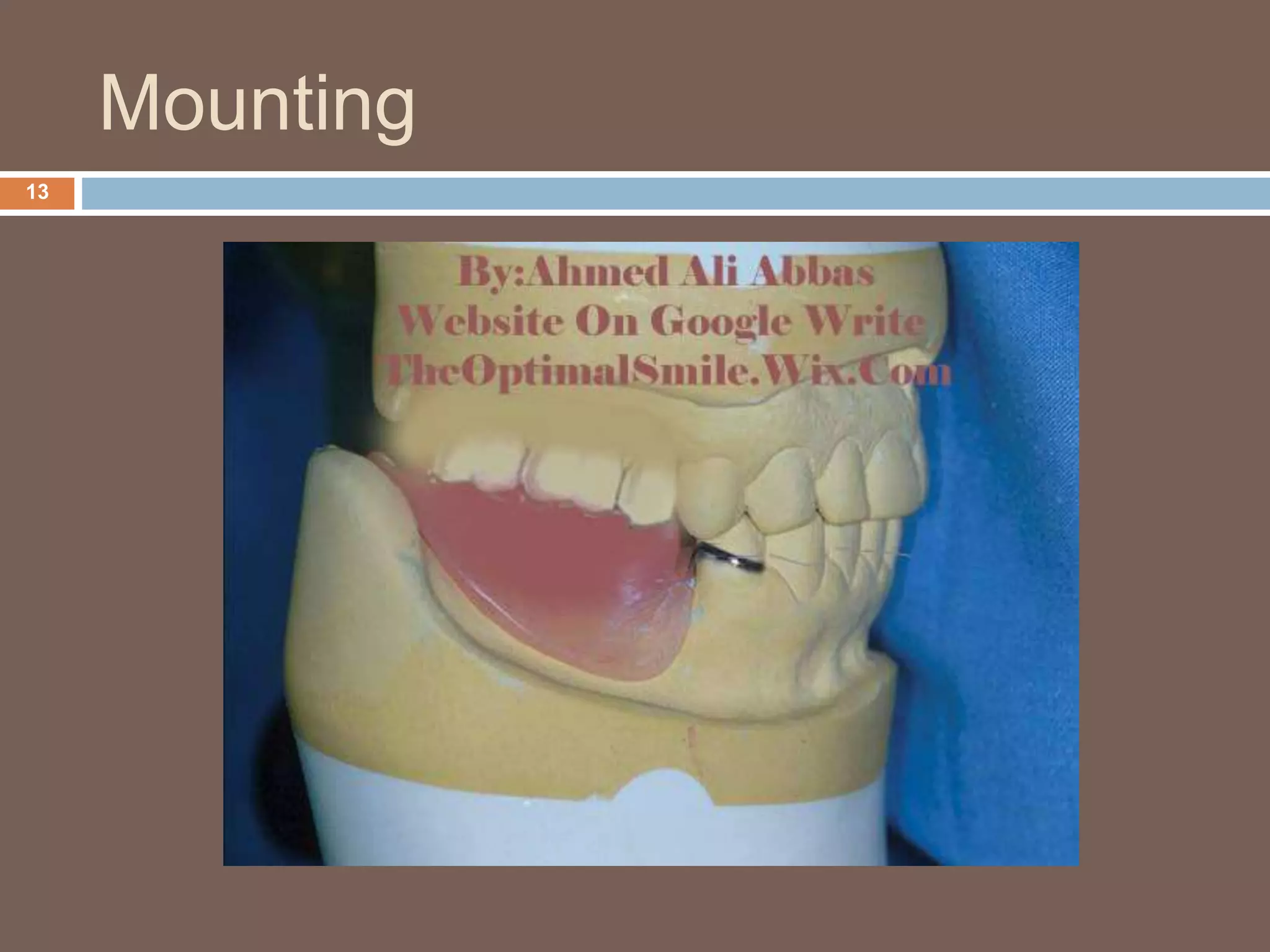 Acrylic type temporary Removable Partial Denture Steps | PPTX