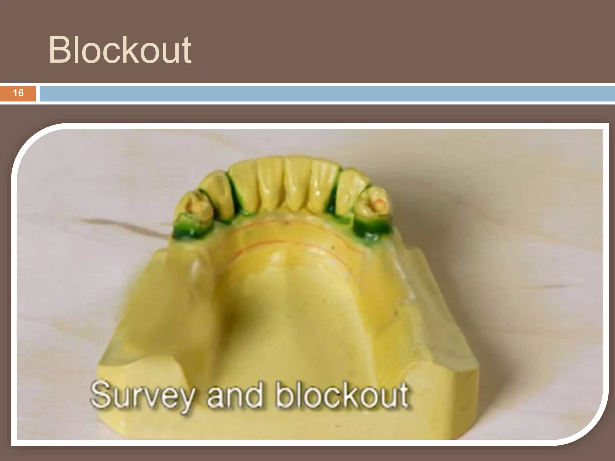 Acrylic type temporary Removable Partial Denture Steps | PPTX