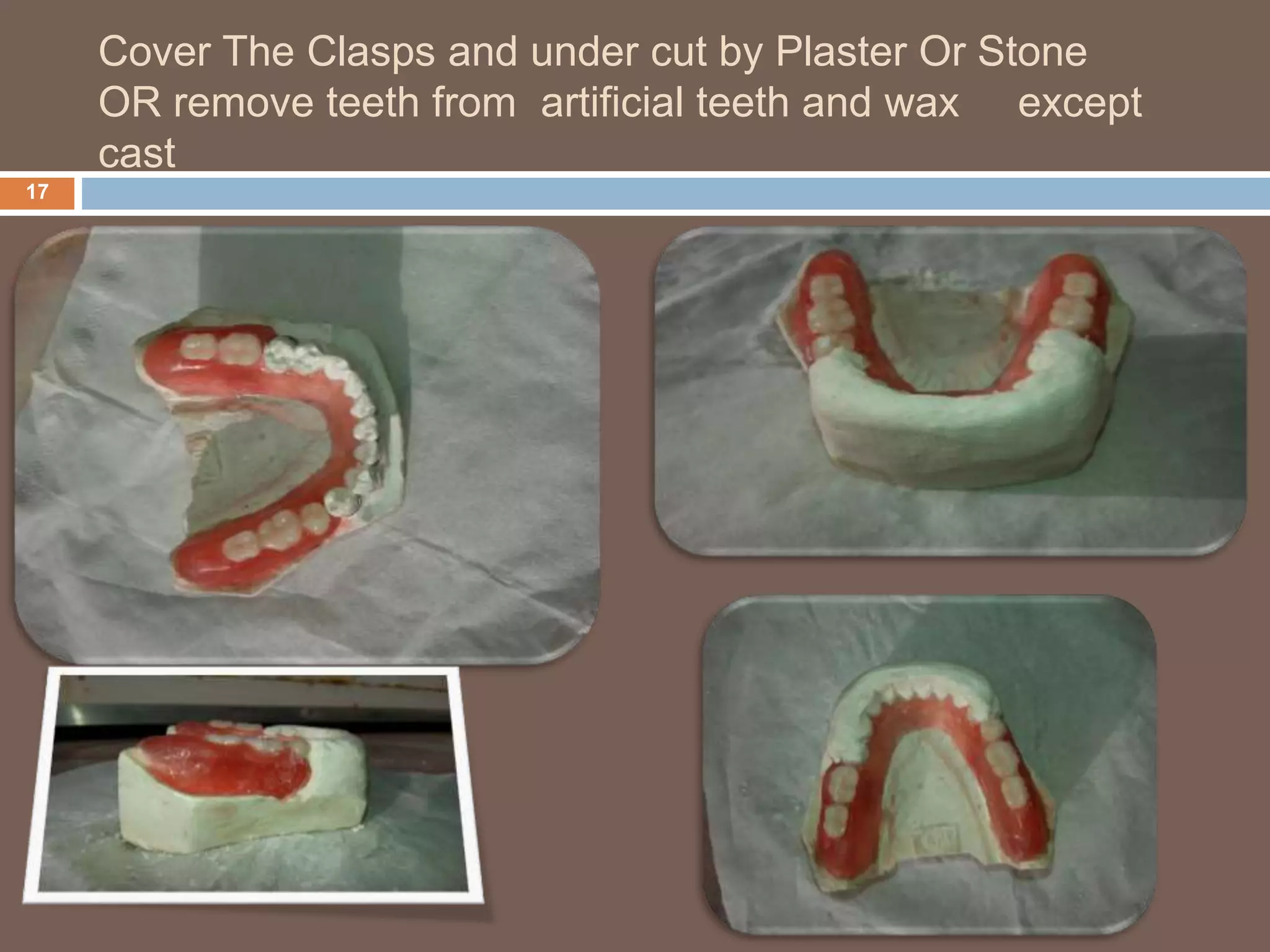 Acrylic type temporary Removable Partial Denture Steps | PPTX