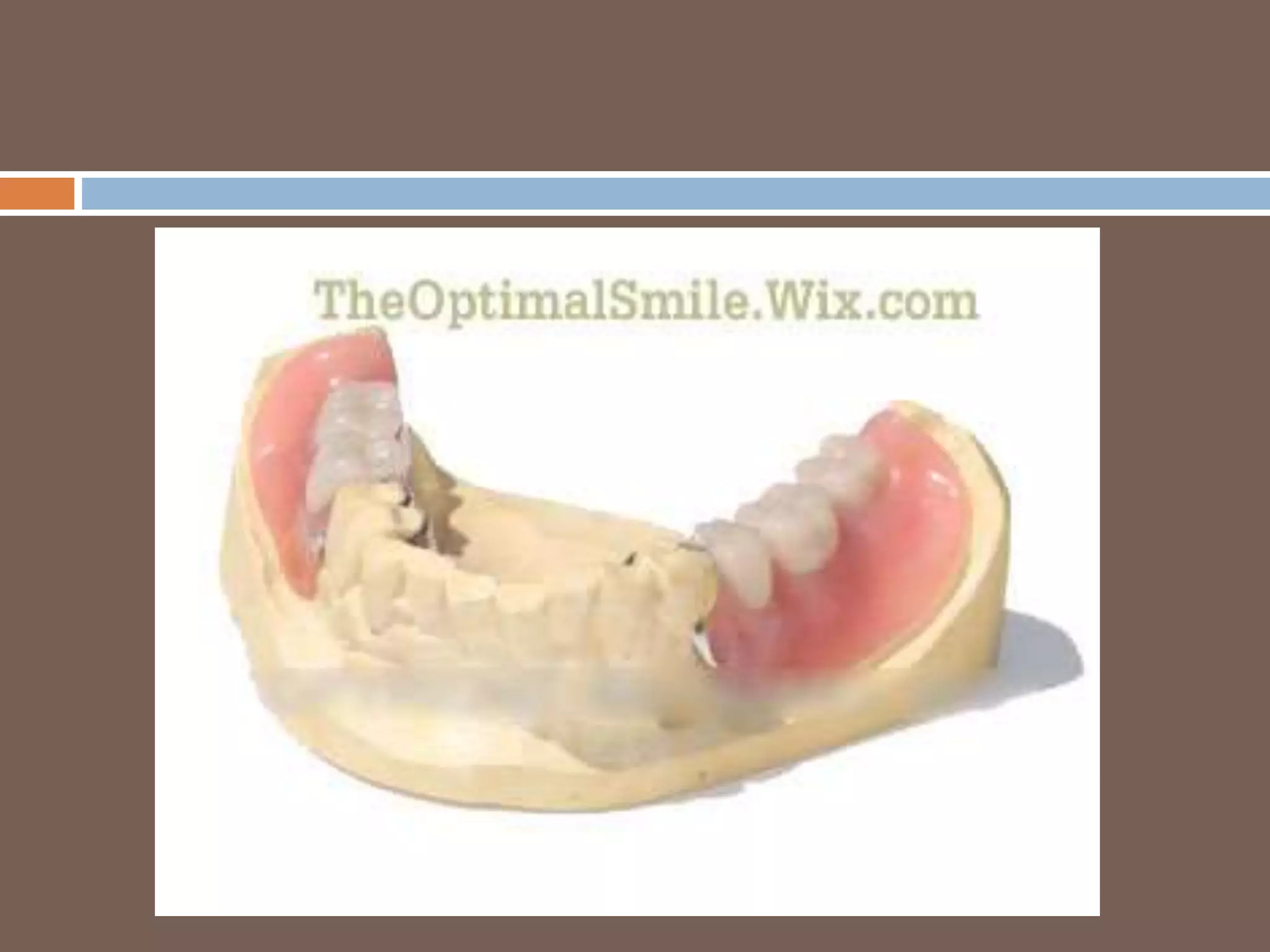 Acrylic type temporary Removable Partial Denture Steps | PPTX