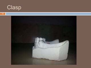 Acrylic type temporary Removable Partial Denture Steps | PPTX