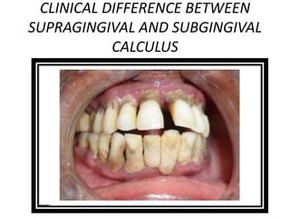 Theories of calculus formation.pptx