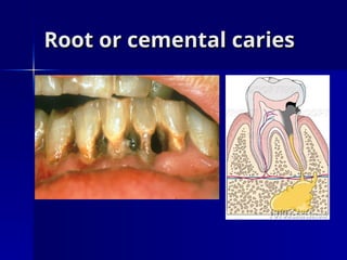 theoriesofdentalcaries-ppt03-100802141217-phpapp01.ppt