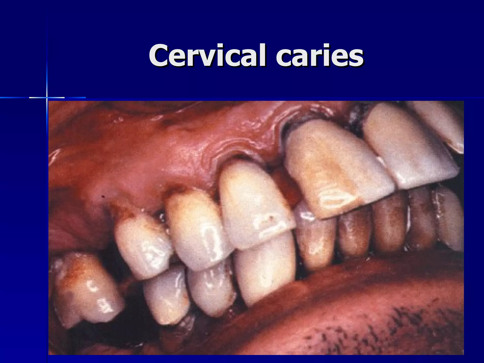 Theories of dental caries.ppt | PPT
