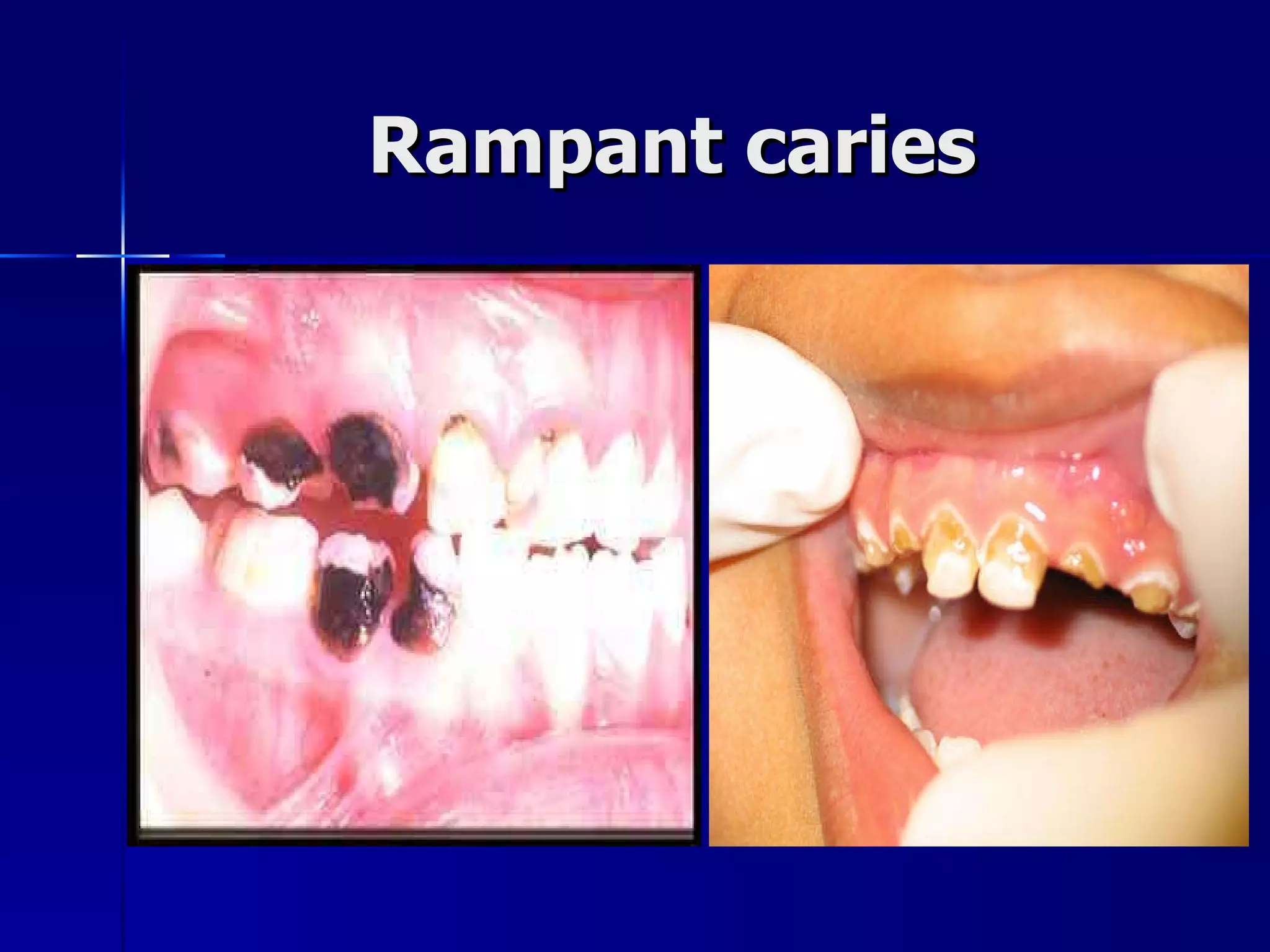 Theories of dental caries.ppt | PPT