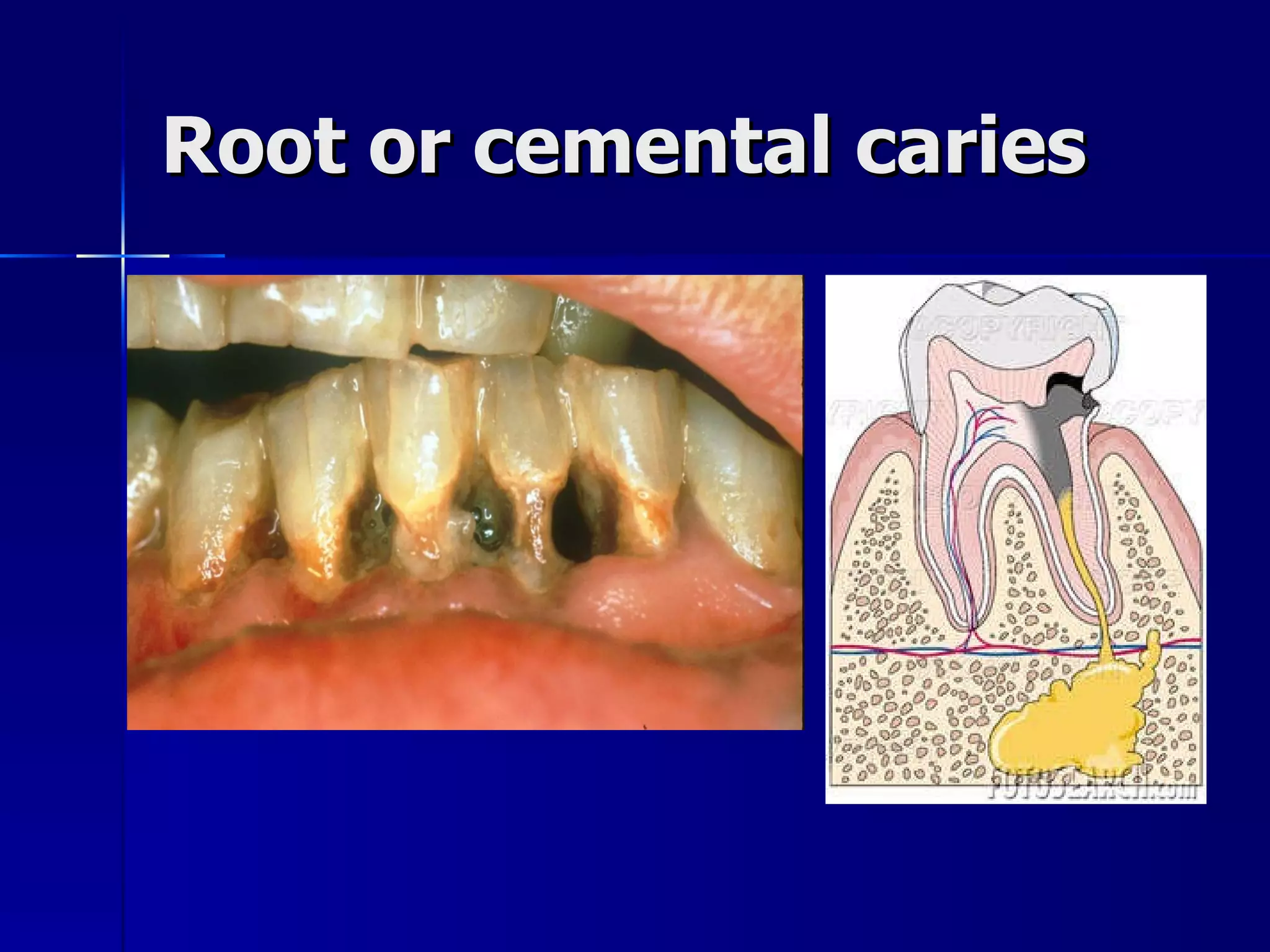 Theories of dental caries.ppt | PPT