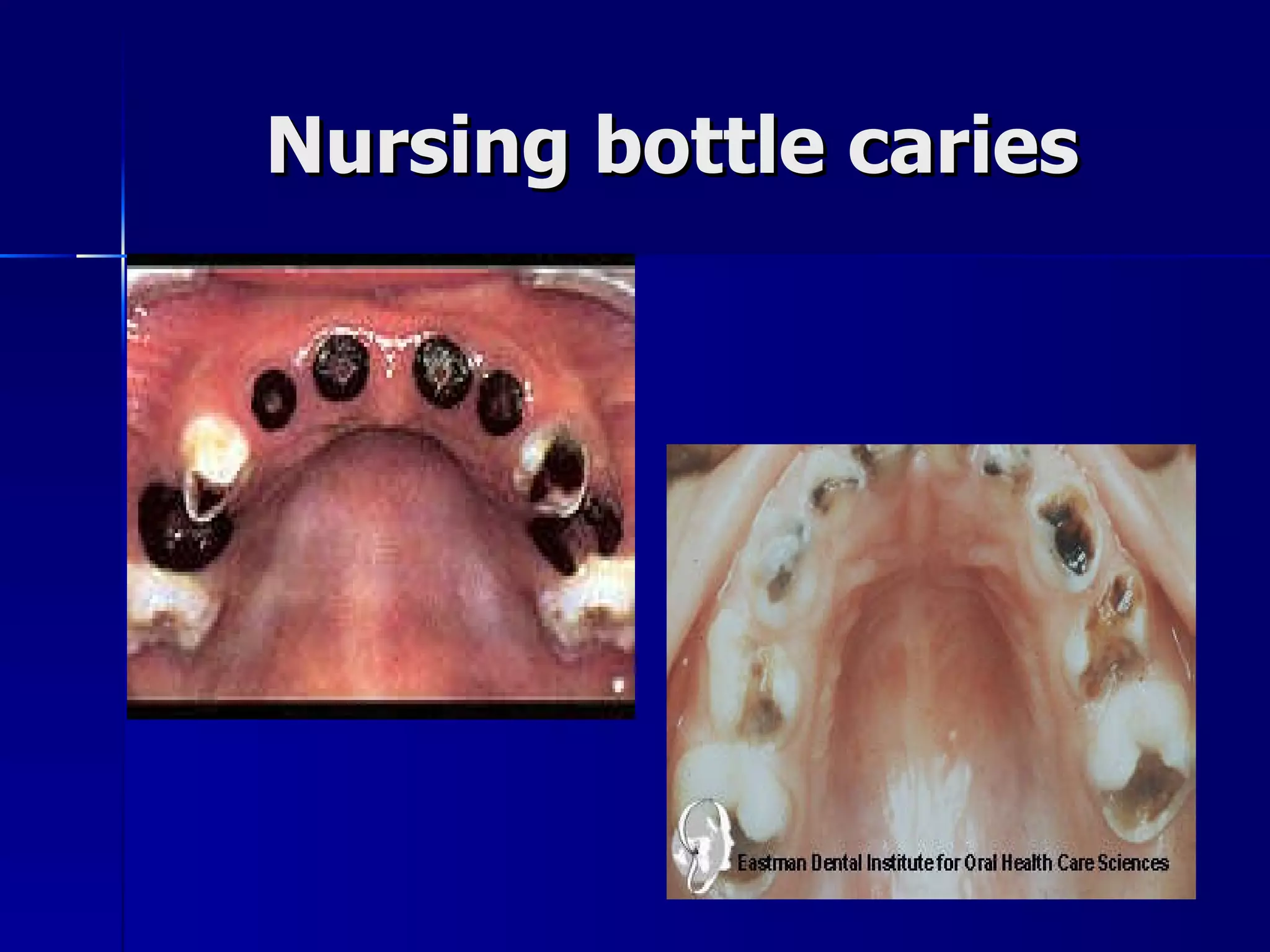 Theories of dental caries.ppt | PPT