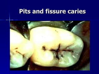 Theories of dental caries.ppt | PPT