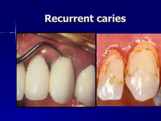 Theories of dental caries.ppt | PPT