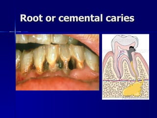 Theories of dental caries.ppt | PPT