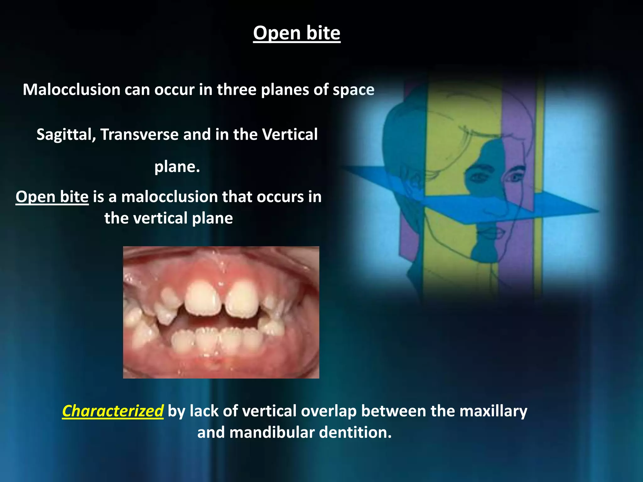 Management of Open Bite - Dr. Nabil Al-Zubair | PDF