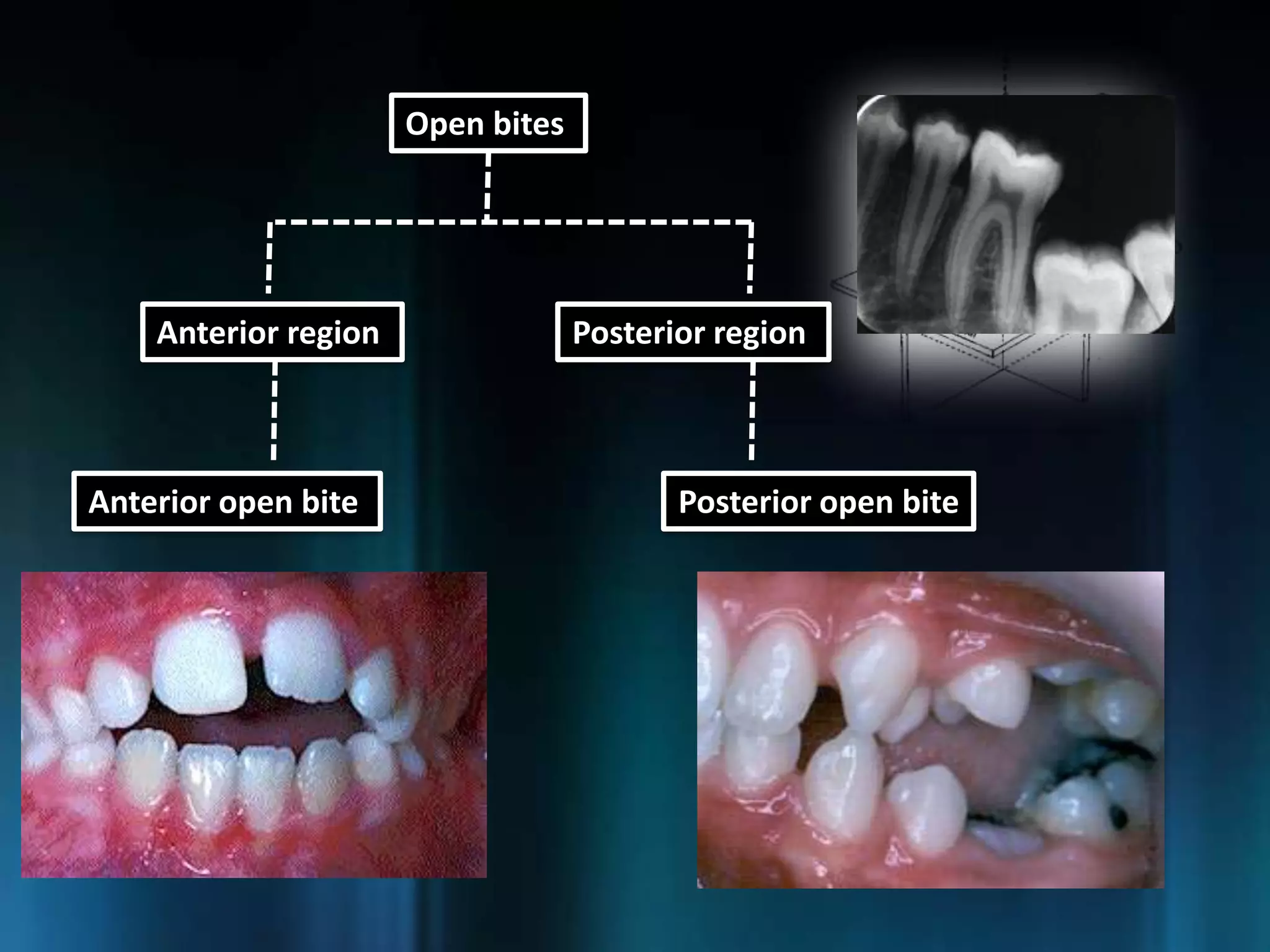 Management of Open Bite - Dr. Nabil Al-Zubair | PDF