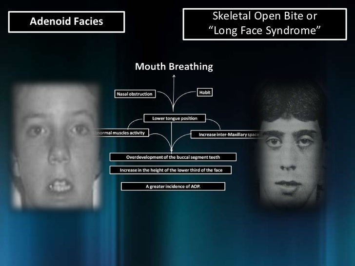Long Face Syndrome Symptoms Causes Mouth Breathing
